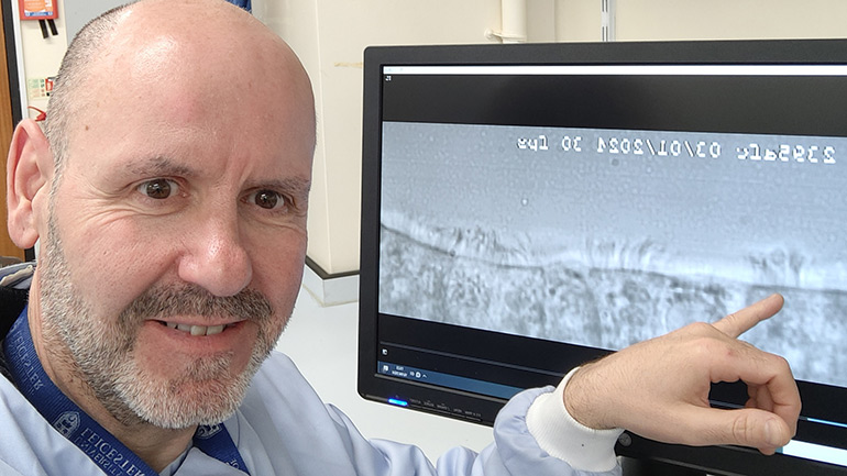 Discovery of a new gene enables the diagnosis for patients with rare ...